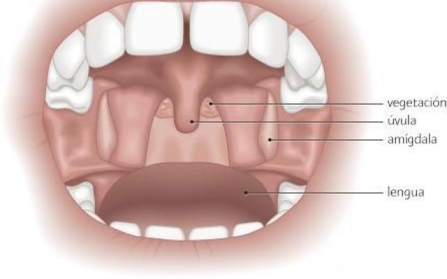 Adenoamigdalectomía: extracción de amígdalas y adenoides