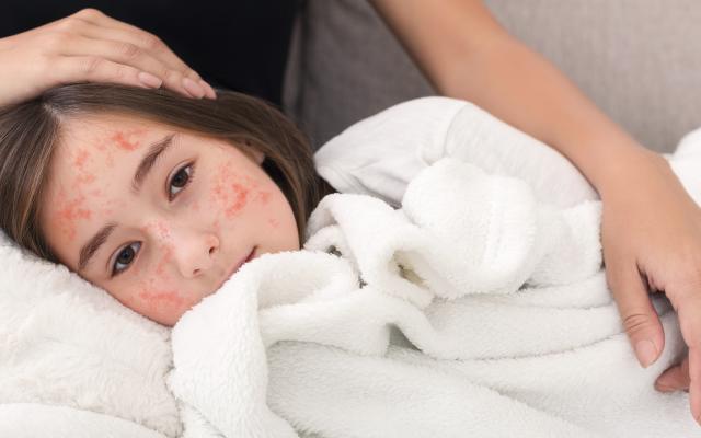 Rubéola: ¿cómo se contagia? – Bupa Latam